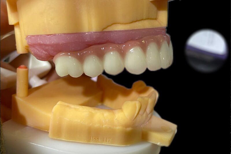 All-on-4 Dental Implants | Full Arch Restoration
